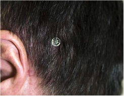 Bone Anchored Hearing Aid (BAHA) Programme - HSE.ie